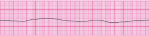 What are the Two Non-Shockable Rhythms in Cardiac Arrest? – Free CPR ...