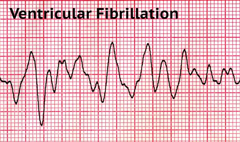 What are the Two Shockable Rhythms in Cardiac Arrest? – Free CPR Training