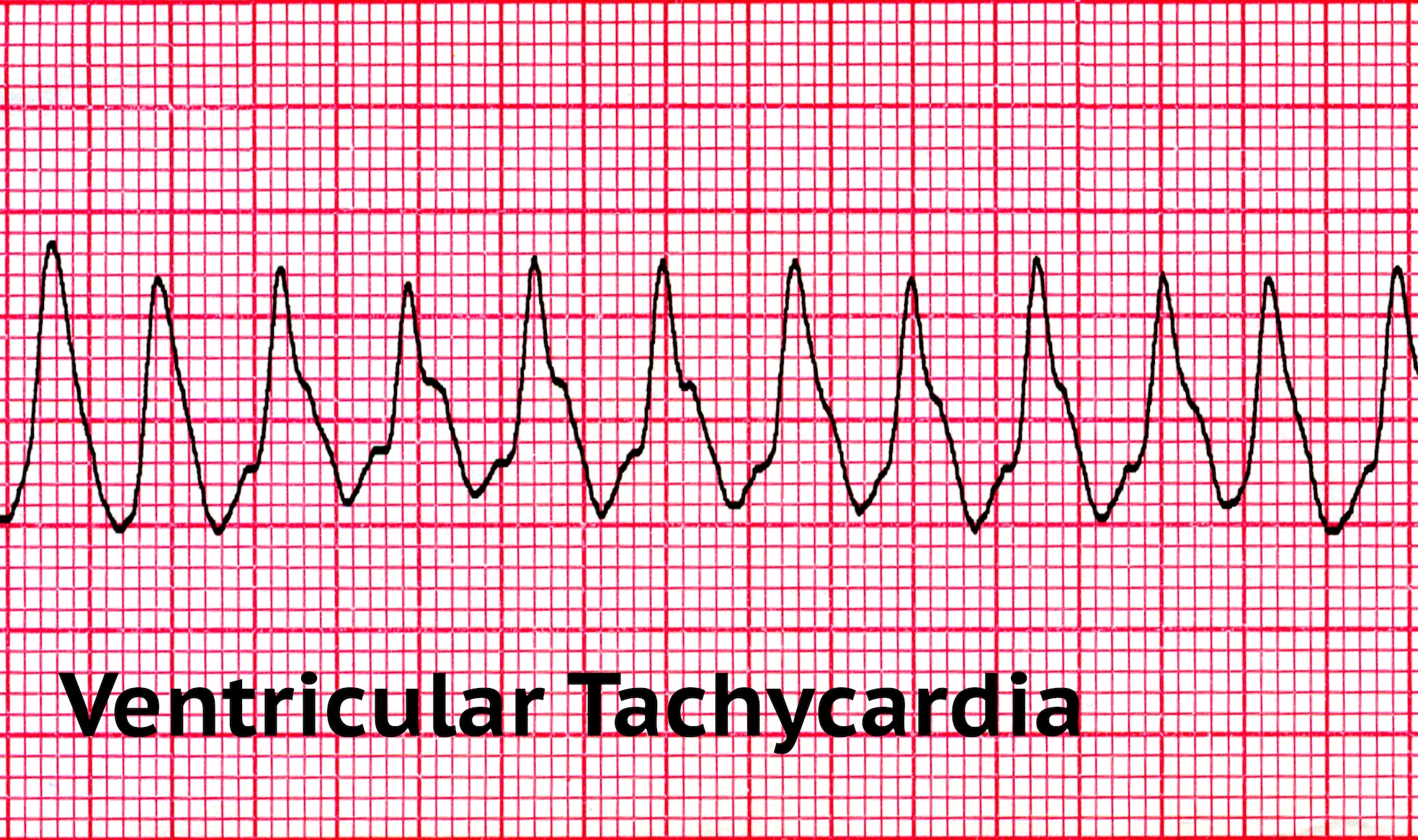 What are the Two Shockable Rhythms in Cardiac Arrest? – Free CPR Training